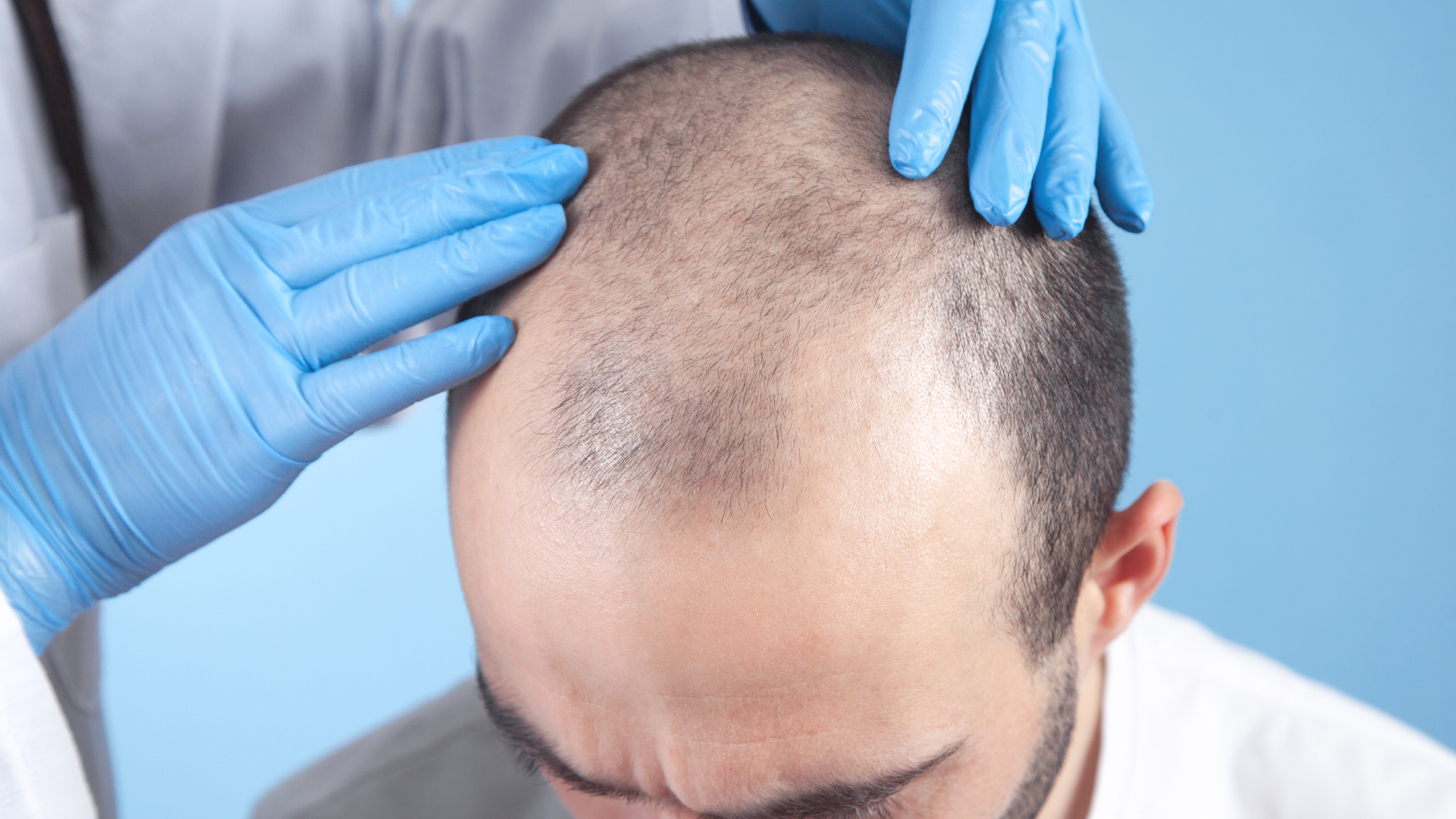 La calvitie précoce chez l'homme : causes, traitements et conseils