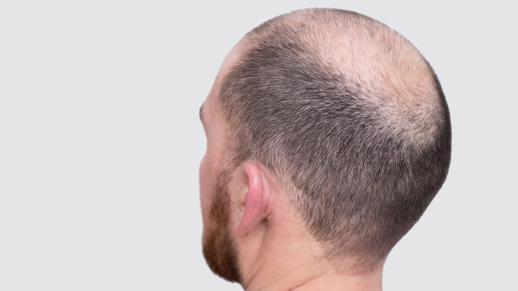 Début de calvitie chez l'homme : les signes à surveiller et les ...