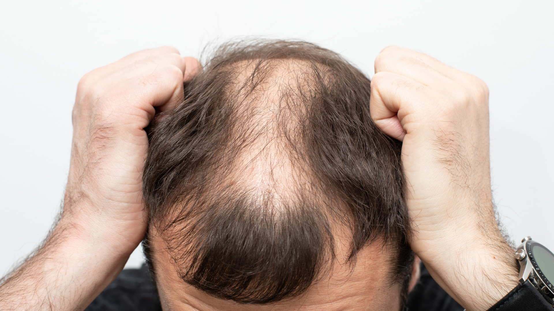 Les causes génétiques, hormonales et environnementales de la calvitie