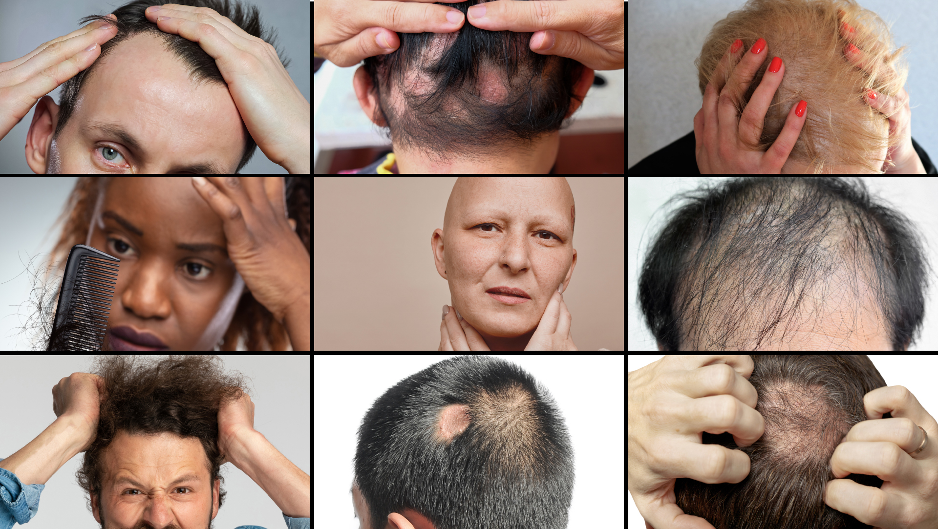 Guide complet des différents types de calvitie chez l'homme et la femme