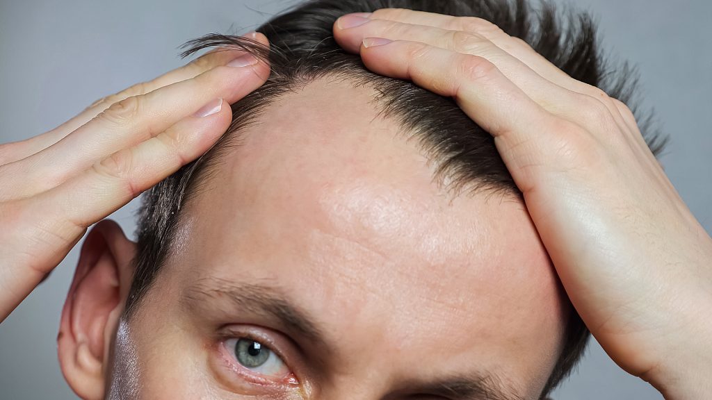 Guide complet des différents types de calvitie chez l'homme et la femme