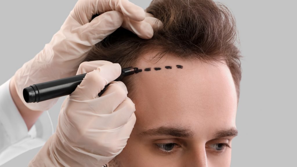 Guide complet des différents types de calvitie chez l'homme et la femme