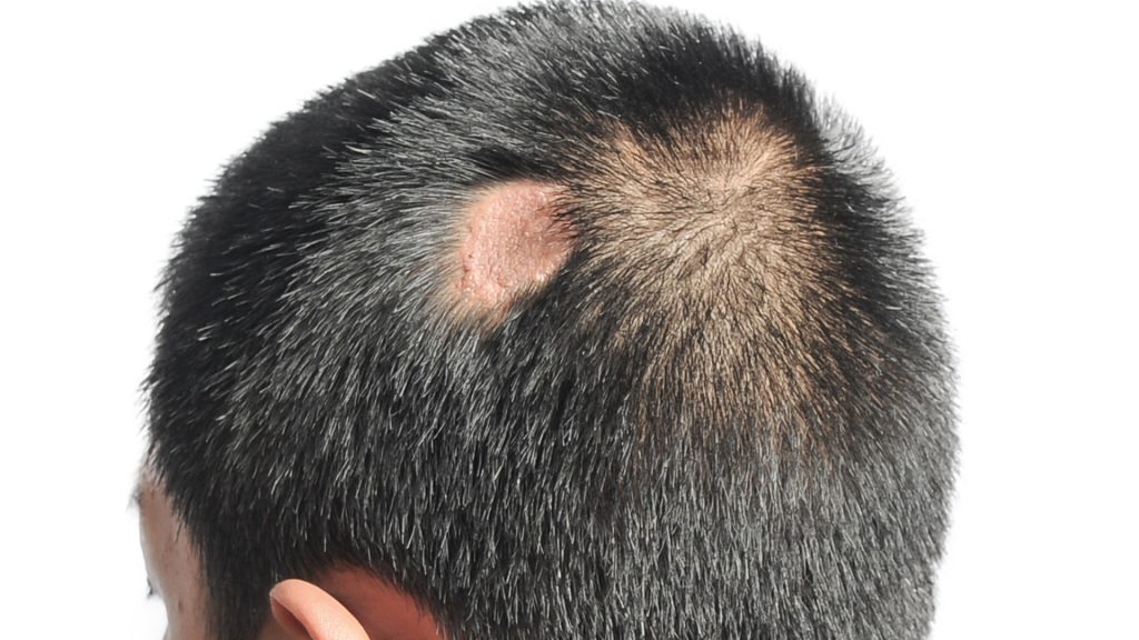 Guide complet des différents types de calvitie chez l'homme et la femme