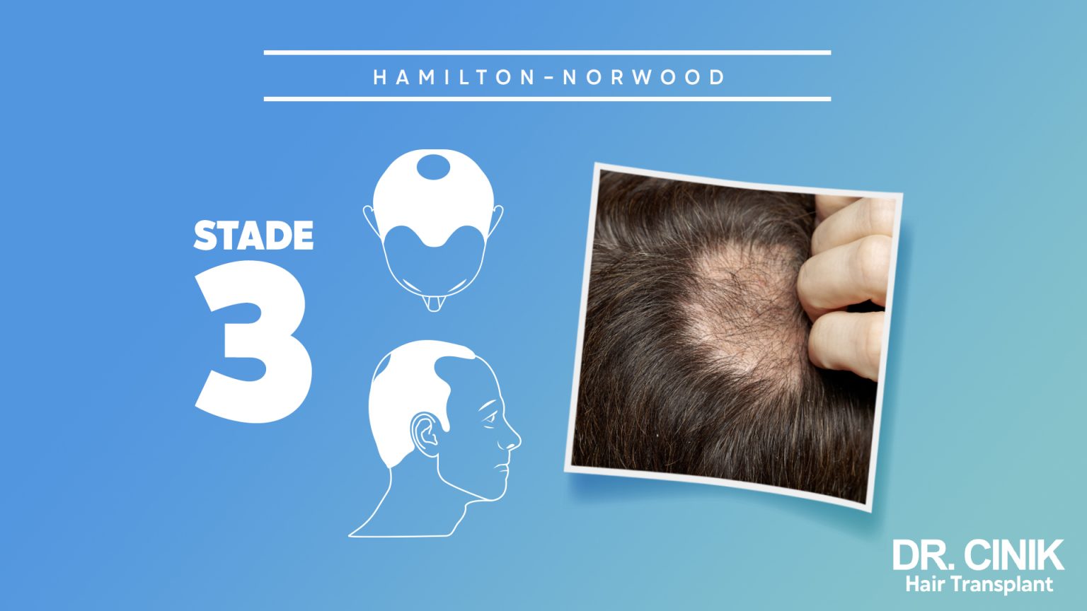 Évolution de la calvitie : Comprendre les stades, les causes et les ...