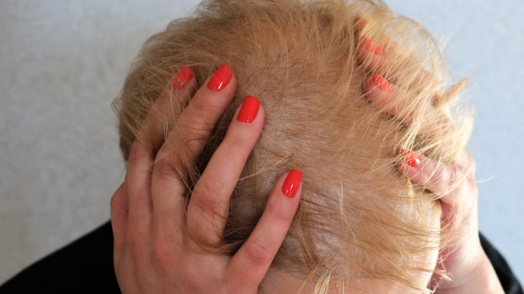 Guide complet des différents types de calvitie chez l'homme et la femme