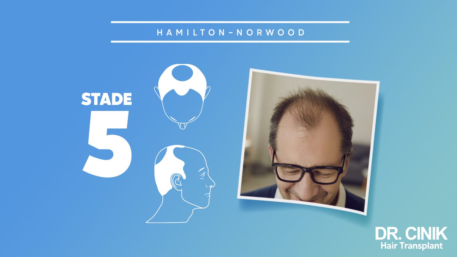 Évolution de la calvitie : Comprendre les stades, les causes et les ...