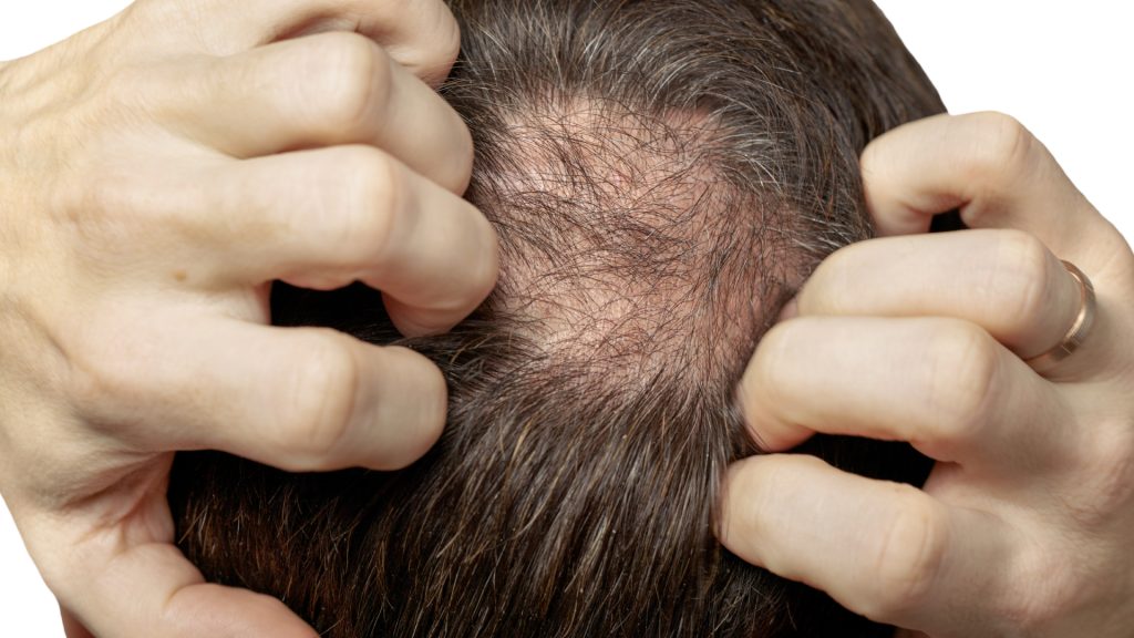 Guide complet des différents types de calvitie chez l'homme et la femme