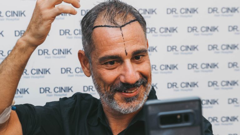 Calvitie : Causes, Évolution et Traitements