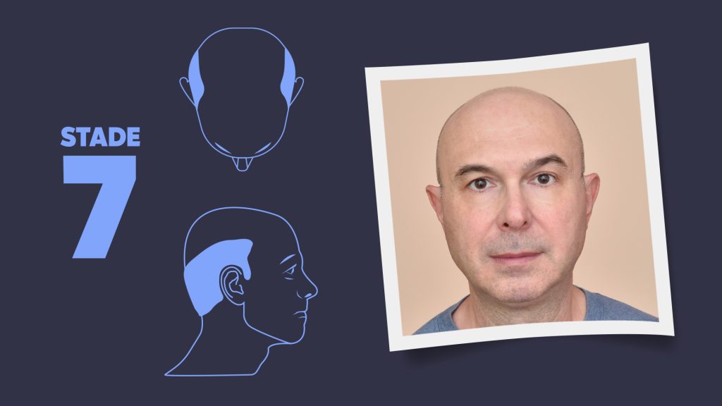 Calvitie : Causes, Évolution et Traitements