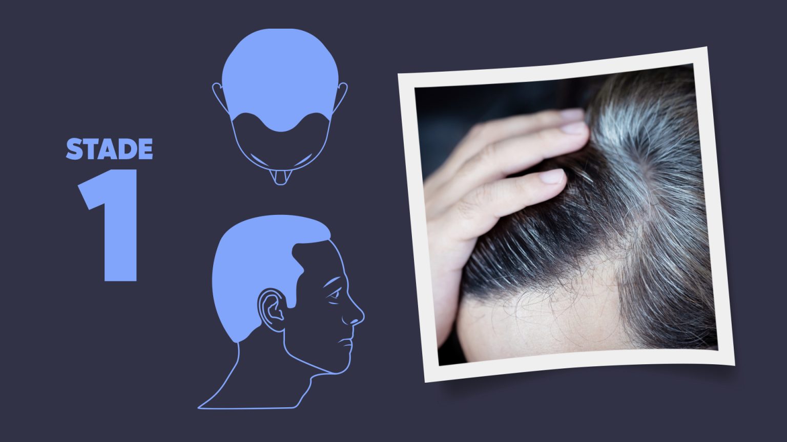 Calvitie : Causes, Évolution et Traitements